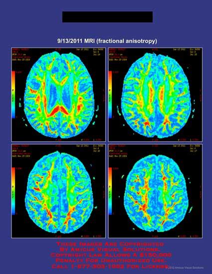 Mri Fractional Anisotropy