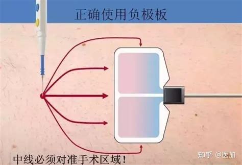 手术室电刀负极板放置的部位 知乎