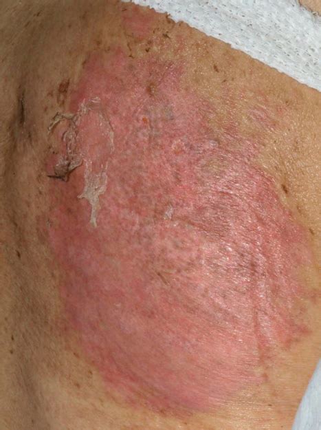 Diffuse Erythematous Rash