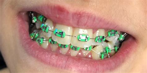 How Green Braces Are Perfect Choice For Your Teeth Braces Explained
