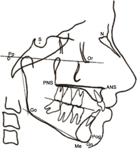 Lateral Cephalometric Landmark Download Scientific Diagram