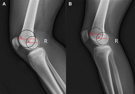 Lateral Femoral Condyle Index Lfci Measurement By Dr The