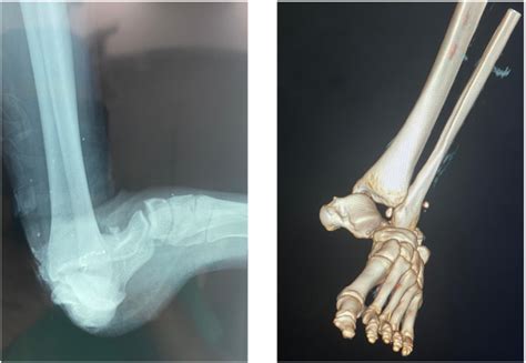 Radiography And Ct Of The Ankle Confirming An Isolated Lateral Subtalar Download Scientific