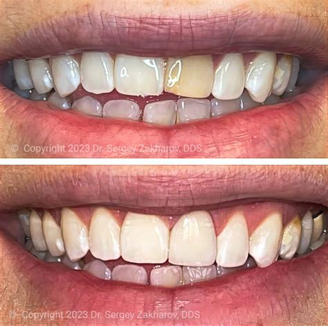 Mastering Dental Color Matching Burbank Dental Lab