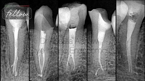Management Of The Complex Anatomy Of Lower Premolars Style Italiano Endodontics