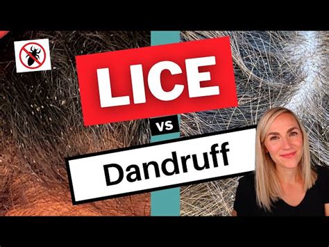 What S The Difference Between Dandruff And Lice Eggs In Hair In Hindi