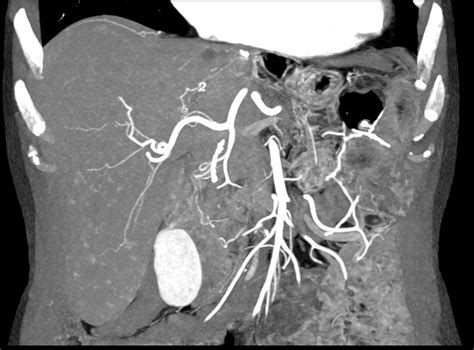 Liver Segmental Anatomy Ct Scan