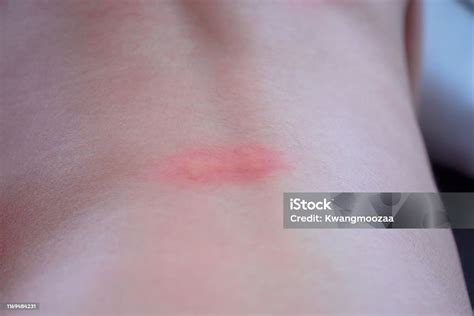 작은 아시아 여자 피부 발진 과 알레르기 와 빨간 반점 원인 에 의해 모기 물린 에 의해 뒤에서 건강관리와 의술에 대한 스톡