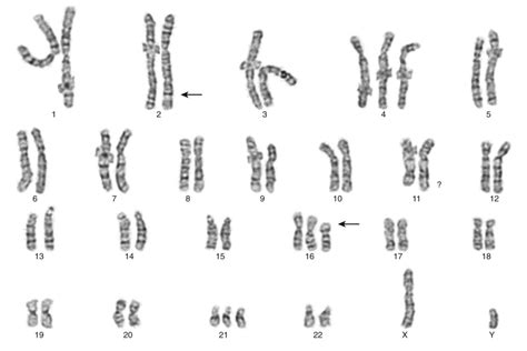 Ewing Sarcoma Karyotype