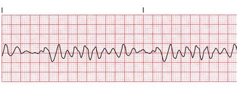 Ventricular Fibrillation Nclex Rn Rex Pn Exam Nursing Refresher Rn Pn