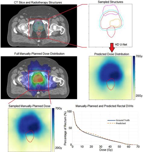 Neural Network Dose Prediction For Rectal Spacer Stratification In Dose‐escalated Prostate