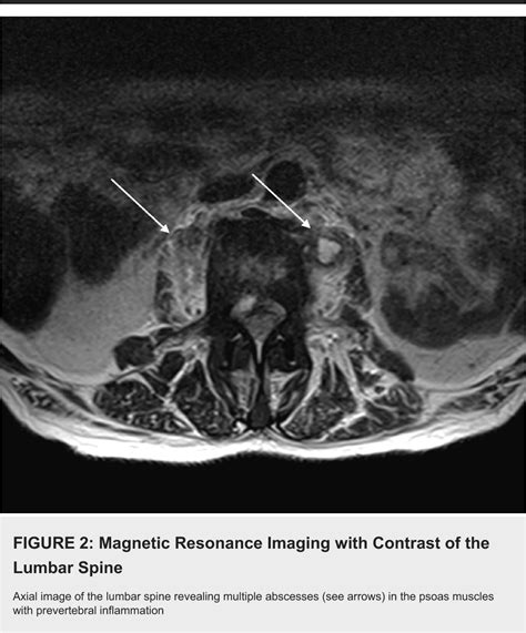 Staphylococcus Caprae Semantic Scholar