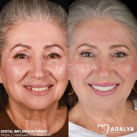 Tooth Implant Turkey Price 2026 Affordable Tooth Implants Cost