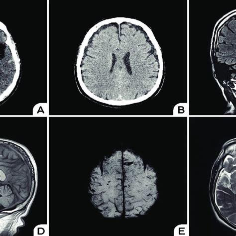 Sagittal Hr CT Reconstruction Of The Temporal Bone Showing Bone Download Scientific Diagram