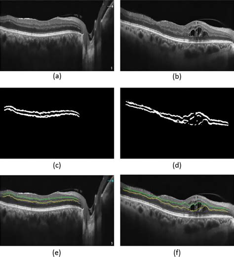 Segmentation Results Using Cubic Spline Interpolation A An Oct Slab Download Scientific