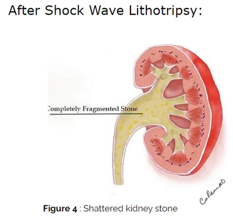 Shock Wave Lithotripsy