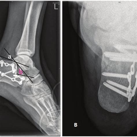 Pdf Minimally Invasive Treatment Of Calcaneal Fracture