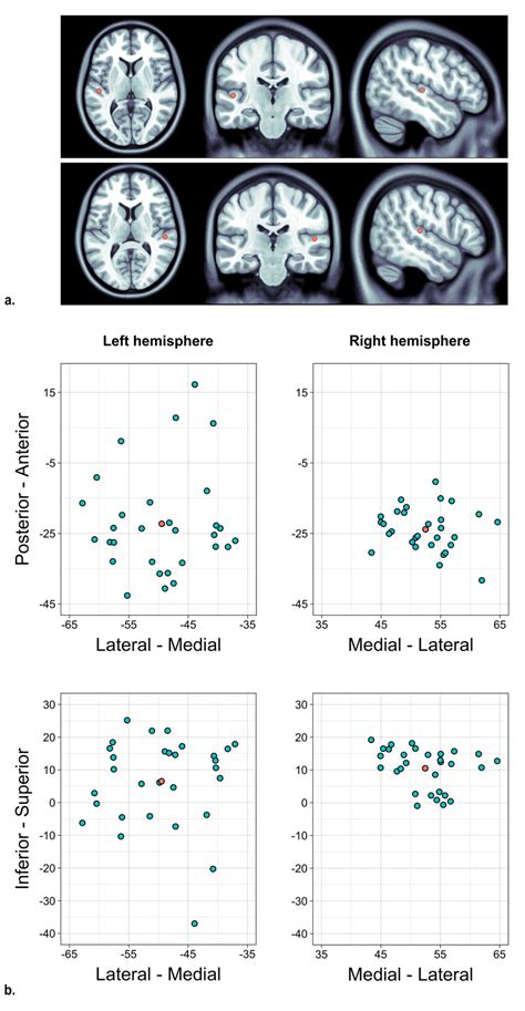 The Localization Of 40 Hz Auditory Steady State Response Assr In Mni Download Scientific