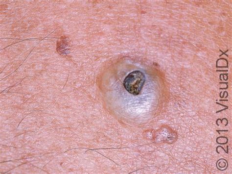 Epidermoid Cyst Sebaceous Cyst Symptoms Treatment And Removal