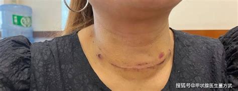 甲状腺癌手术后能活多少年对寿命影响大吗做好这件事生存时间是很可观的 治疗 治愈 患者