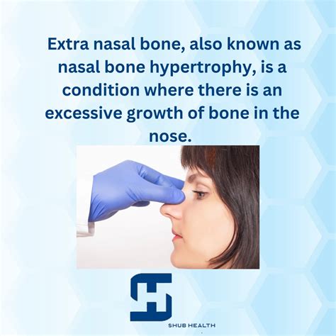 Ppt Nasal Bone Surgery Correcting Extra Bone 1 Powerpoint