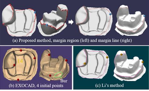 Cavity Margin Line Extraction From The Closed Margin Region A With