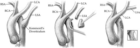 Figure 3 From Reoperation After Vascular Ring Repair Semantic Scholar