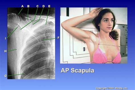 Shoulder Exam Labeling Final Flashcards Quizlet