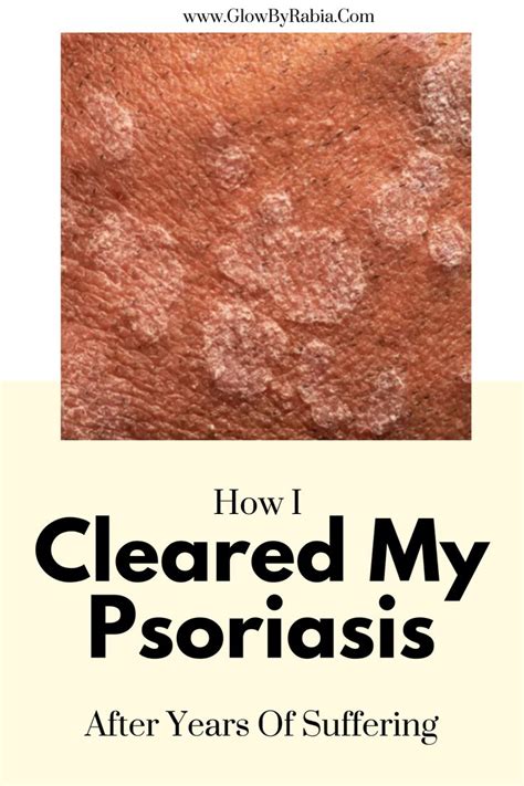 Pin On Psorisis