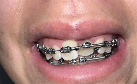 Retainers Hawley Vs Essix Rbraces