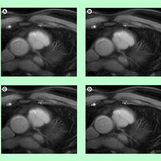 PDF MRI Artifacts And Correction Strategies