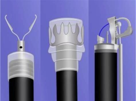 Prevention And Endoscopic Management Of Colon Perforations Related To Snare Resection World