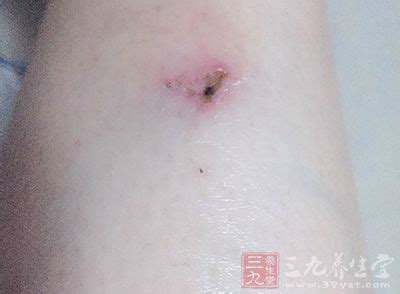脸上长菜花状小疙瘩 脸上菜花状图片大全 菜花疣的症状图片 大山谷图库