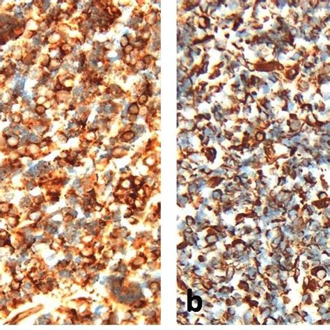 Immunohistochemistry A Diffuse Membranous Staining For Cd99 In Tumour