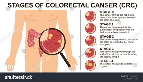 Large Intestine Cancer Tumor