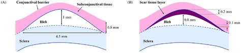 Two Dimensional Geometry Of The Filtering Bleb A Shape And