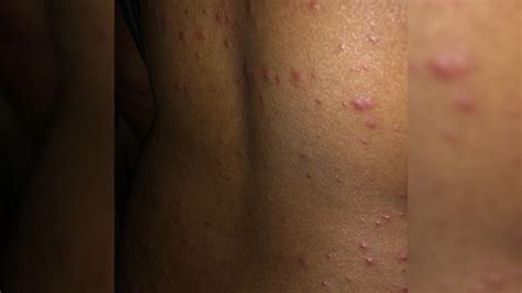 What Causes Dots On Skin At Netjulianblog Blog