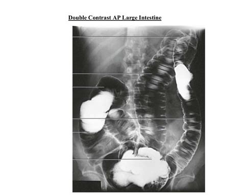 Double Contrast Ap Large Intestine Diagram Quizlet