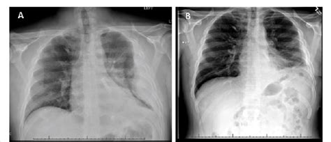 A Chest X Ray Obtained On Admission Showing A Large Loculated Pleural Download Scientific