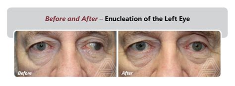 Enucleation Of The Eye