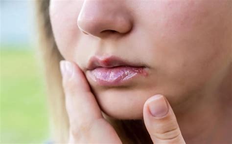Herpes Symptoms Causes Types Treatment Prevention Lifebei