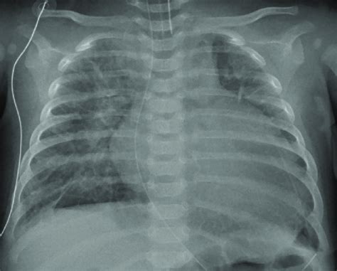 Linear Atelectasis On Chest X Ray At Patricia Flores Blog