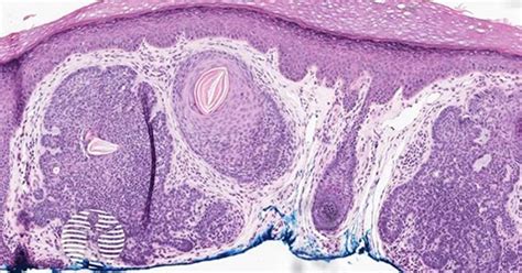 Basal Cell Carcinoma Histology
