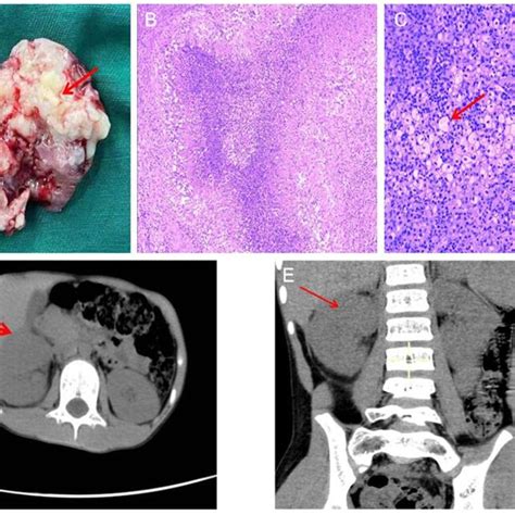 A Lesion Tissue Specimen Multiple Central Necrotic Granulomas In The