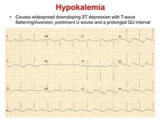 St Segment In Ecgst Elevation And St Depression Pptx