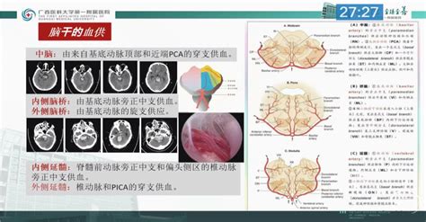 周全教授：原发性高血压脑干出血的神经内镜手术入路选择 脑医汇