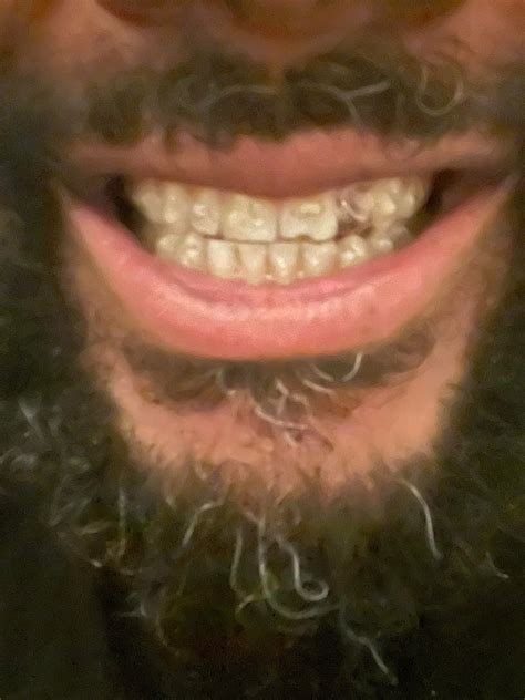 Refinement Trays 3 12 R Invisalign