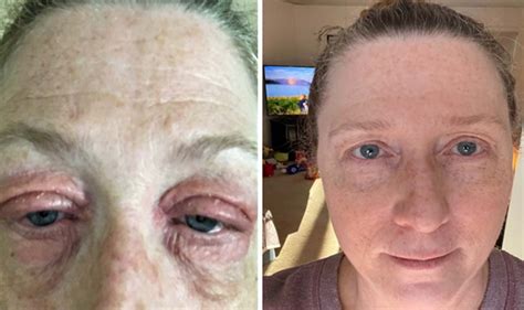 Woman Says Menopause Symptoms Made Her Look Like A Demon Monster Due To Blepharitis Express