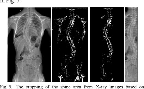 Figure 1 From Feasibility Of Spine Segmentation In Ml Based Recognition Of Vertebrae In X Ray