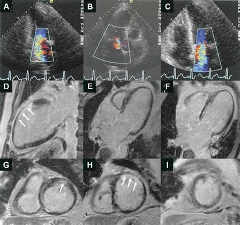 Transthoracic Color Doppler Echo Images In The 2 Chamber A 3 Chamber
